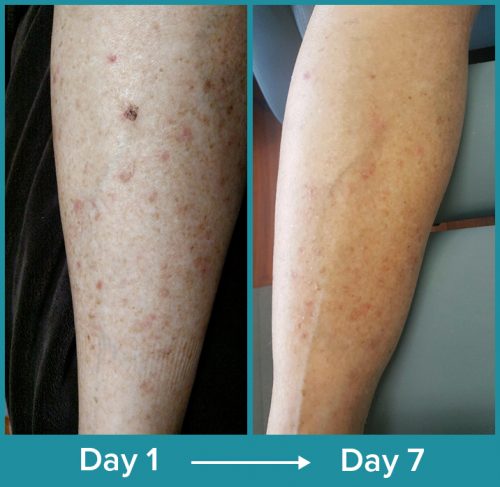 Review - Chemo Rash - CP - NeoGenesis UK Pro