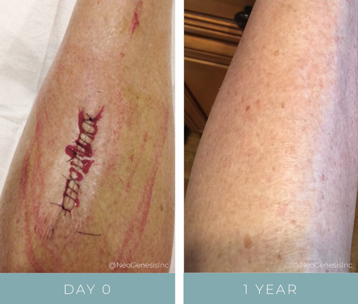 Post Surgery Scar Reduction NeoGenesis Recovery Testimonial Review
