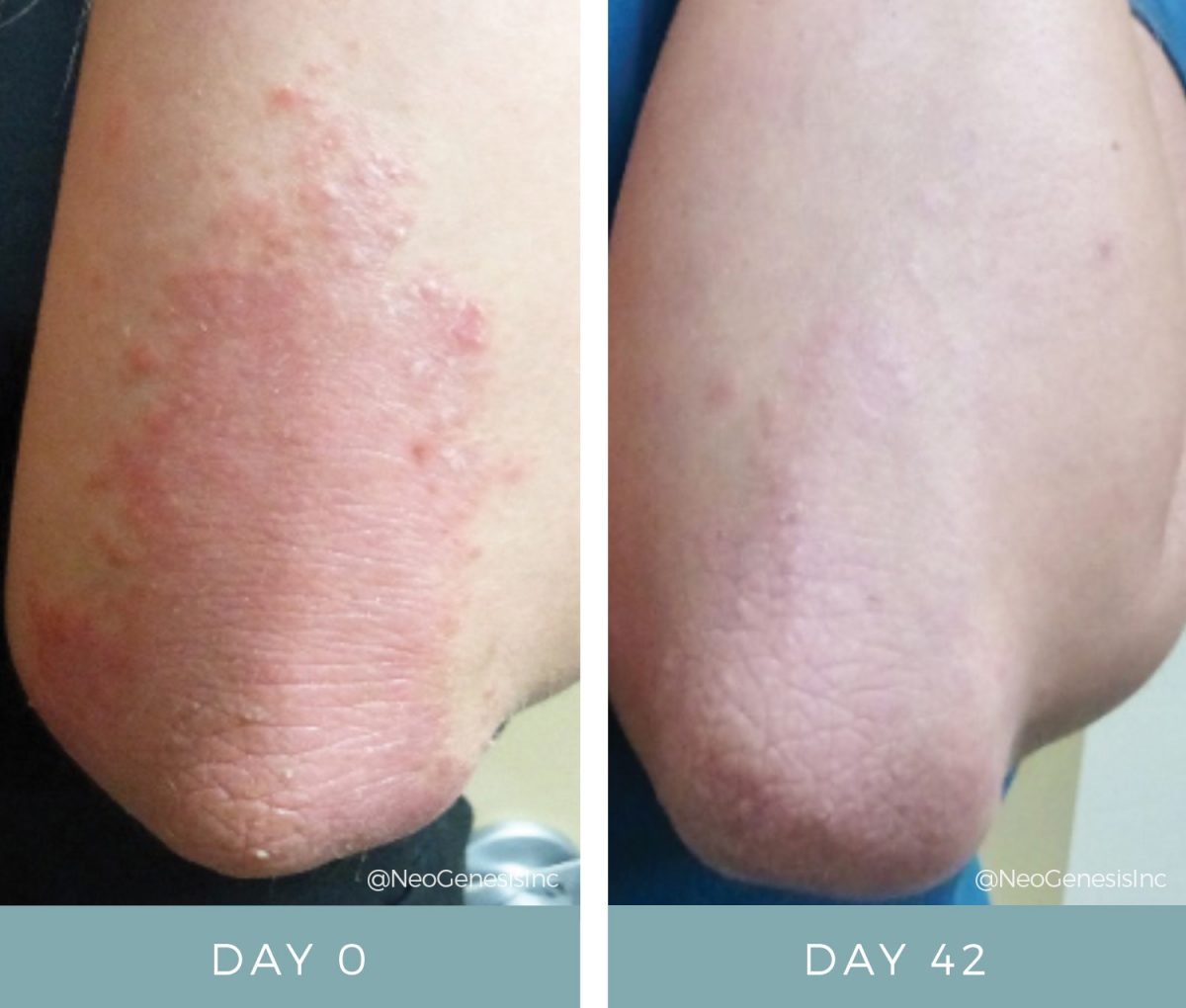 Psoriasis Awareness Support for Skin Care Professionals